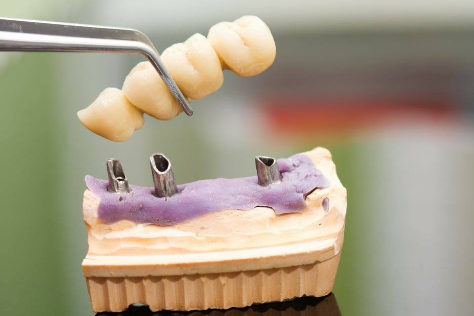 Da li je zubni most idealno rešenje za nadoknadu izgubljenog zuba?